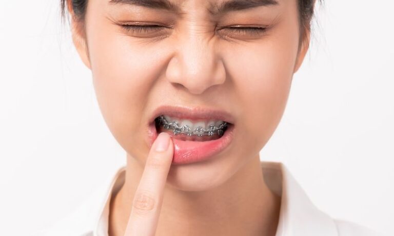 The Ultimate Guide to the Parts of Braces - Frey Orthodontics